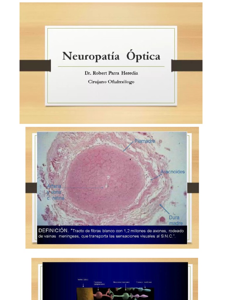 Neuropatia Óptica | PDF