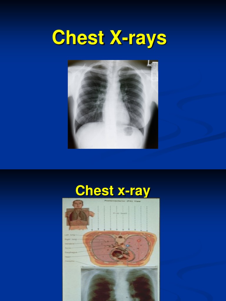 Chest X Rays | PDF | Thorax | Lung