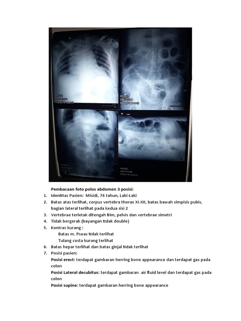 Pembacaan Foto Polos Abdomen 3 Posisi | PDF