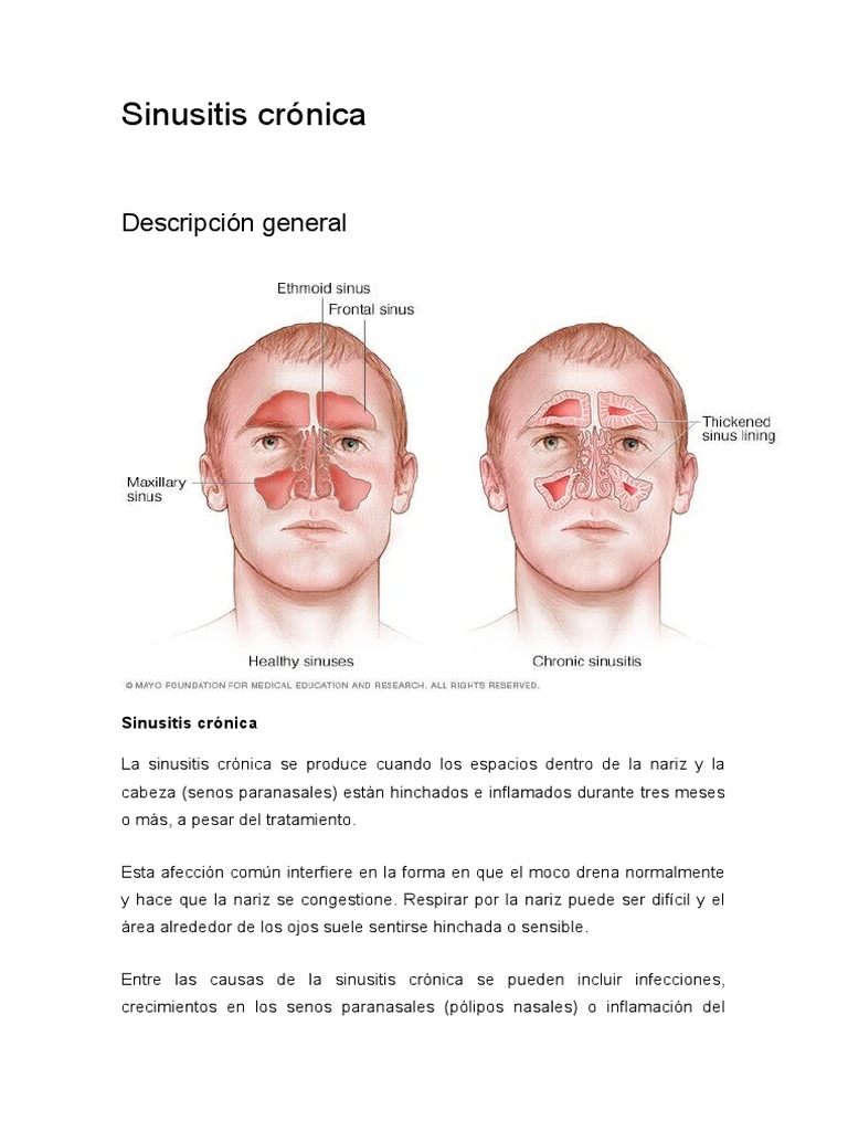 Sinusitis Crónica | PDF | Alergia | Resfriado comun