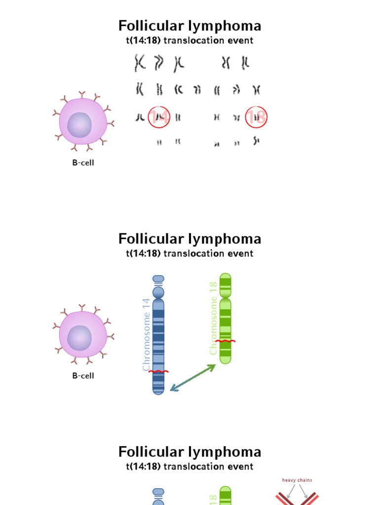 Follicular Lymphoma: T (14:18) Translocation Event | PDF | Bcl 2 | Oncogene