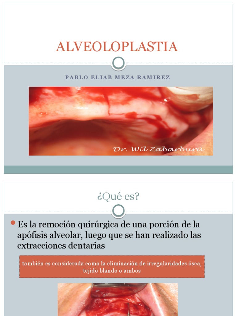 ALVEOLOPLASTIA | PDF | Hueso | Anatomía
