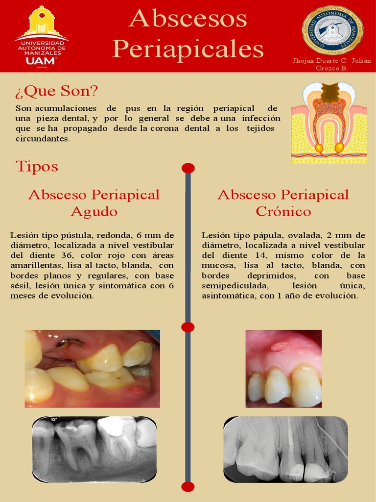 Infografia Abscesos Periapicales | PDF | Estudios de idiomas extranjeros