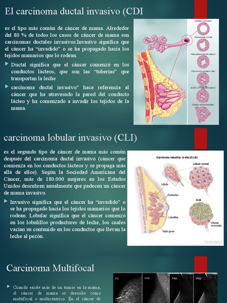 El Carcinoma Ductal Invasivo (CDI | PDF | Cáncer de mama | Cáncer
