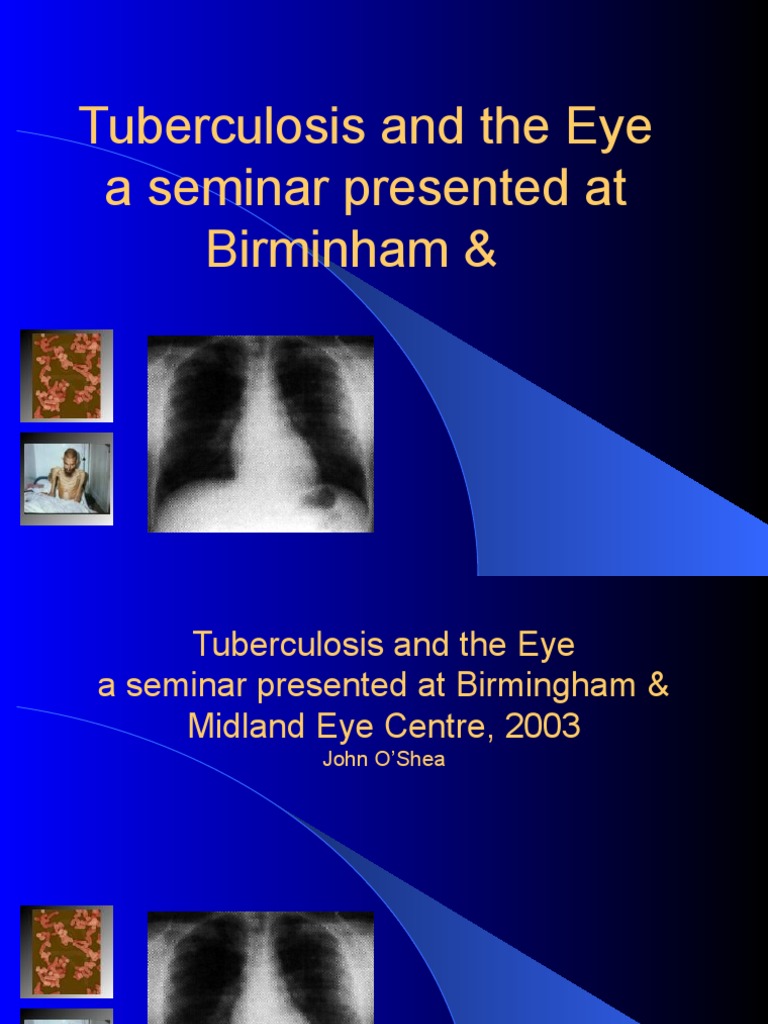 Tuberculosis and The Eye | PDF