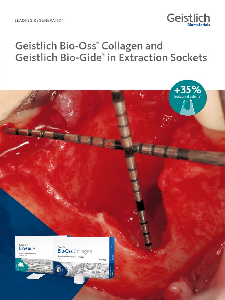 Geistlich Bio-Oss Collagen and Geistlich Bio-Gide in Extraction Sockets ...