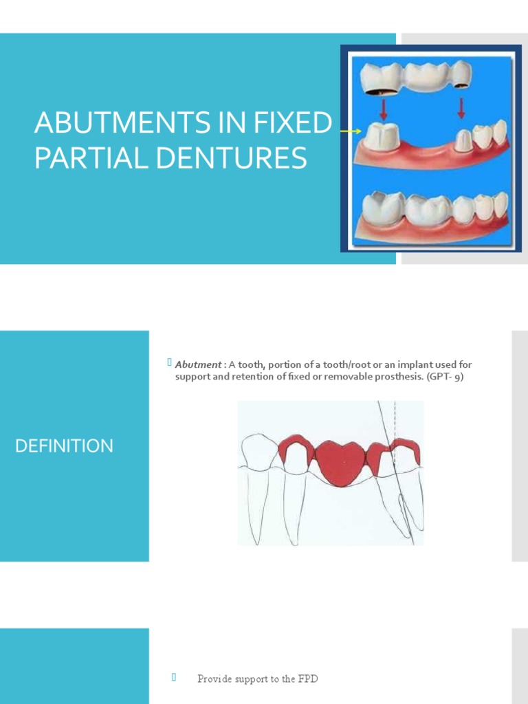 Parts Of Fixed Partial Denture