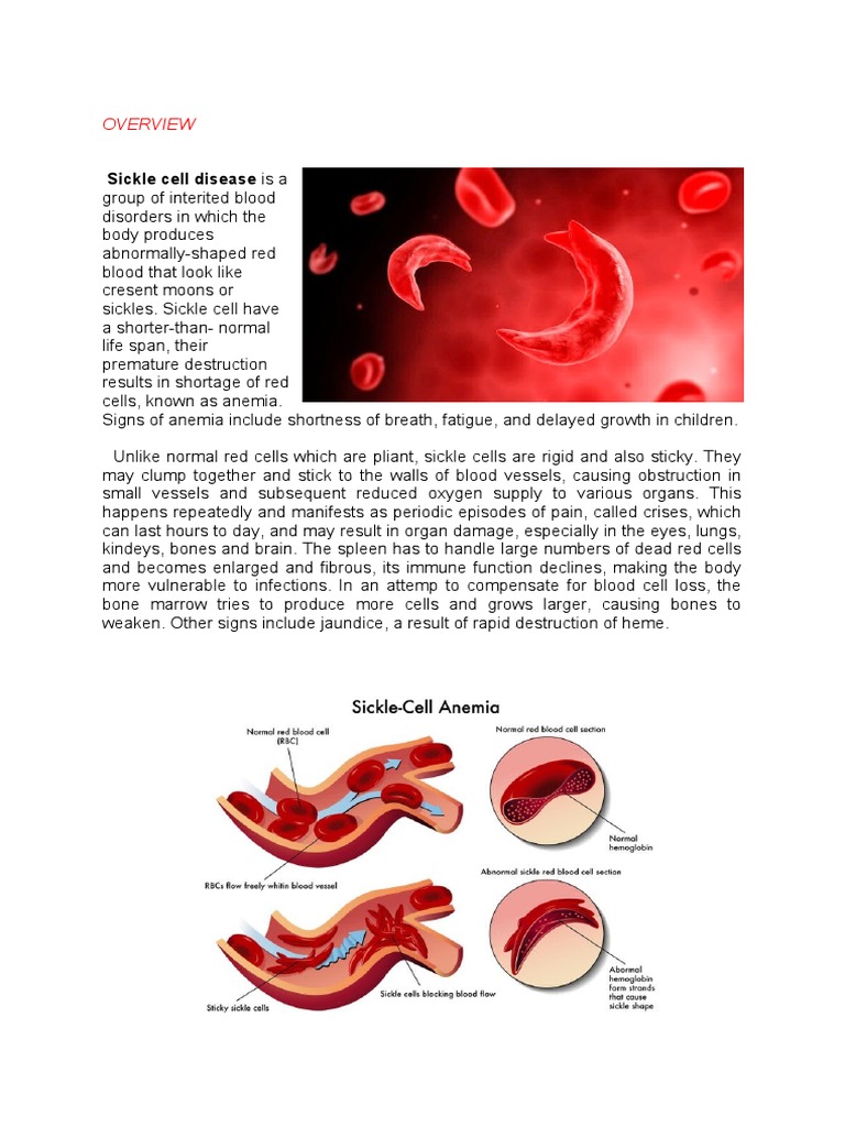 What Is Sickle Cell Disease | PDF | Blood | Gene Therapy