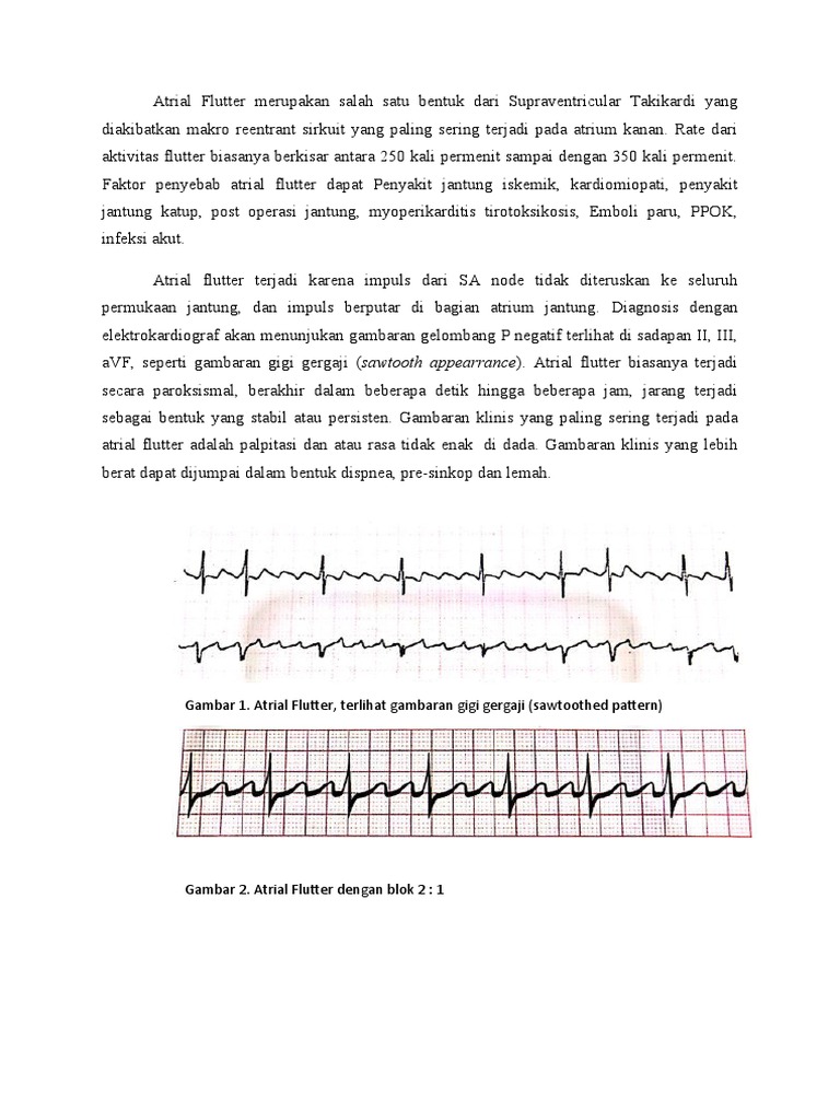 Atrial Flutter | PDF