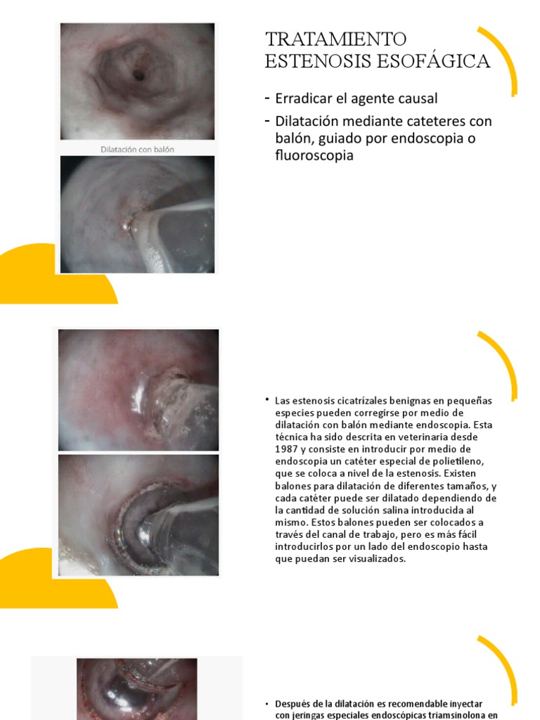 TRATAMIENTO ESTENOSIS ESOFÁGICA | PDF | Endoscopia | Estómago