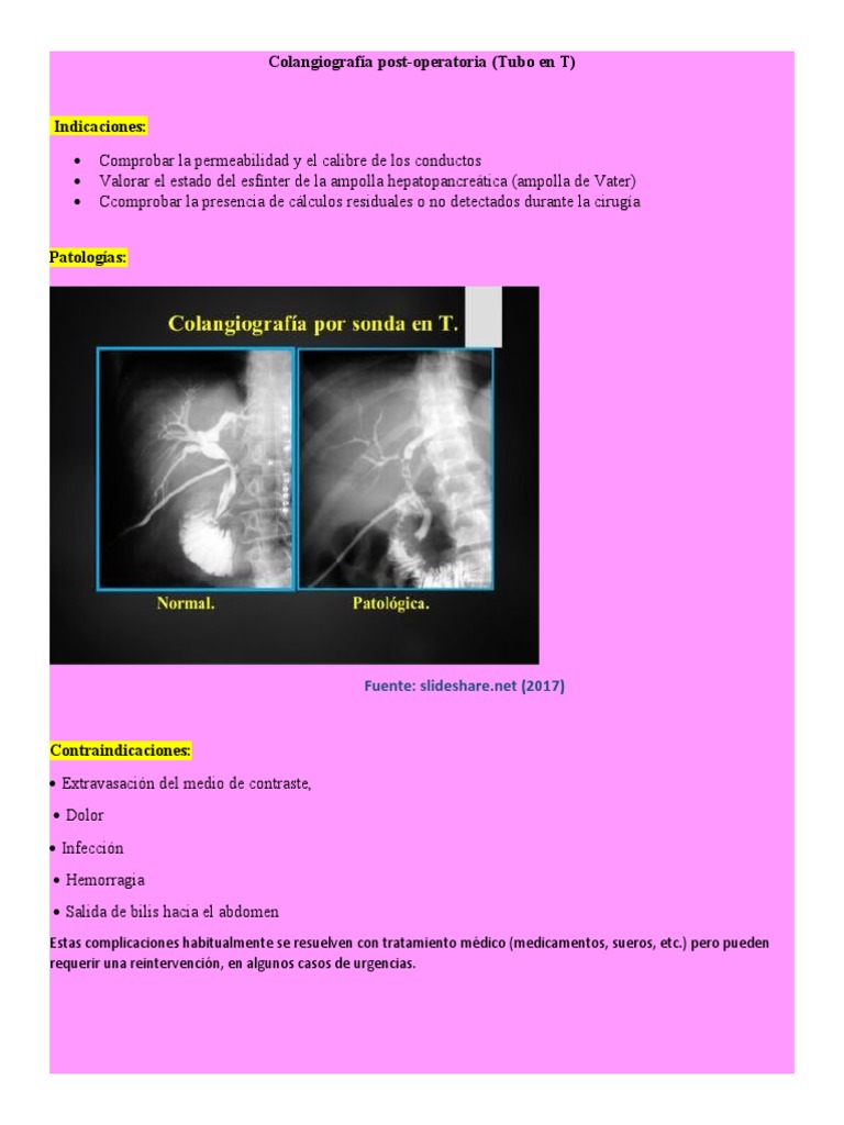 Colangiografía Post-Operatoria (Tubo en T) | PDF