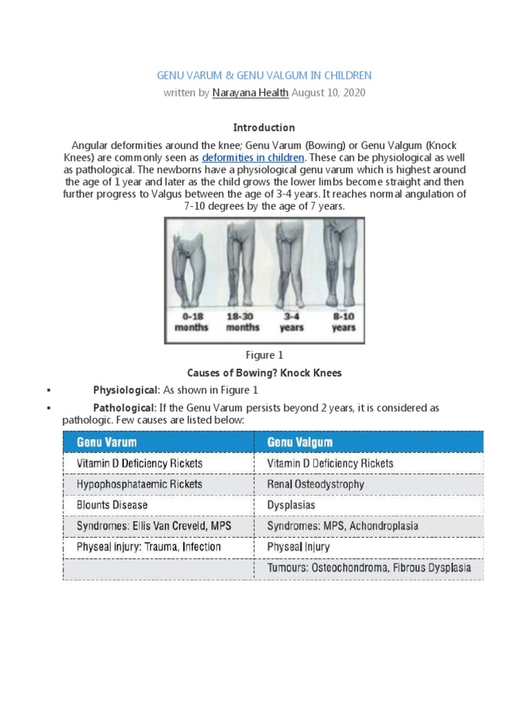 Genu Varum & Genu Valgum in Children: Written by August 10, 2020 | PDF ...