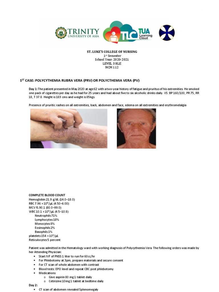 1 Case: Polycythemia Rubra Vera (PRV) or Polycthemia Vera (PV) | PDF ...