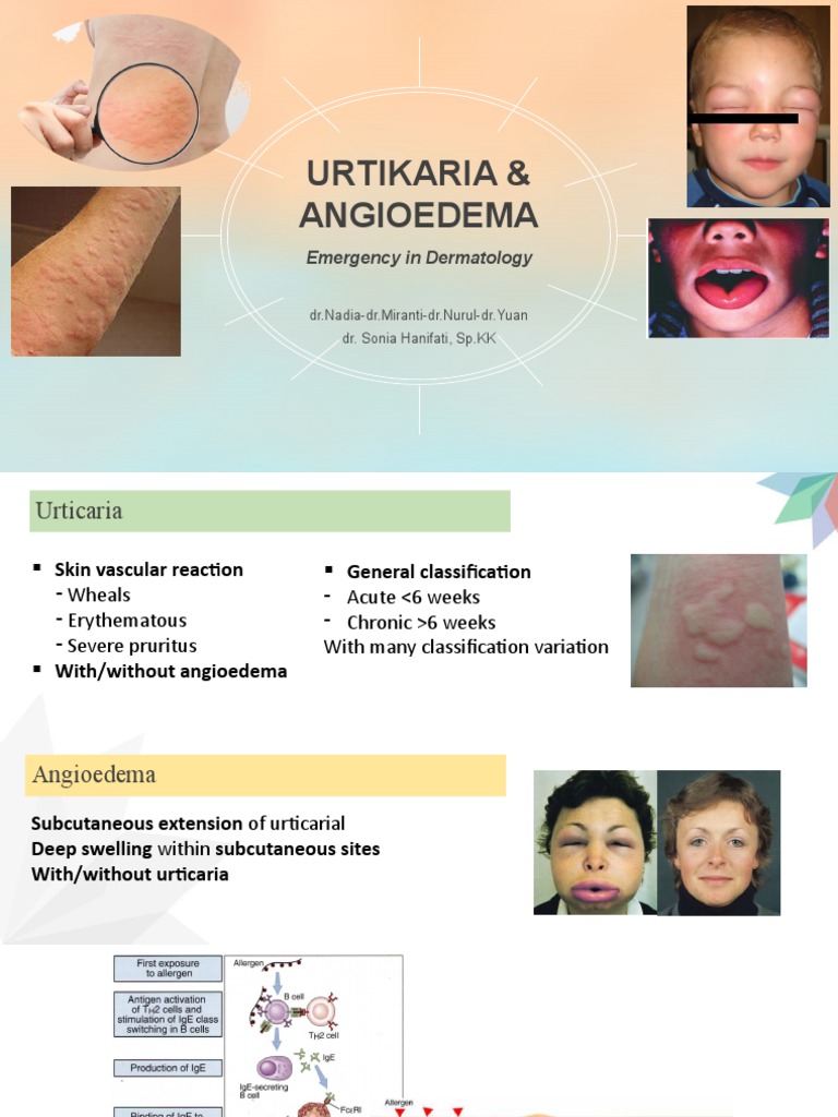 Urtikaria Angioedema | PDF