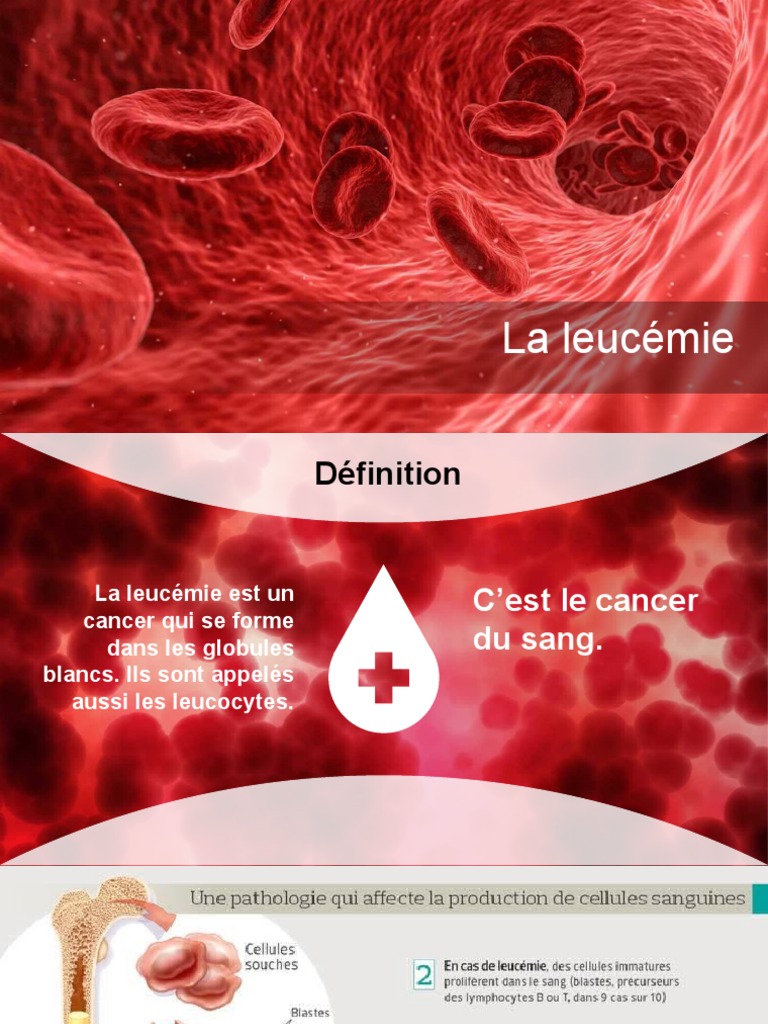 Leucemia | PDF | Leucémie | Maladies et troubles