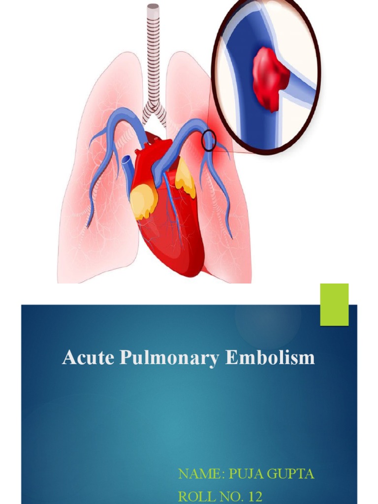 Acute Pulmonary Embolism | PDF | Vein | Embolism