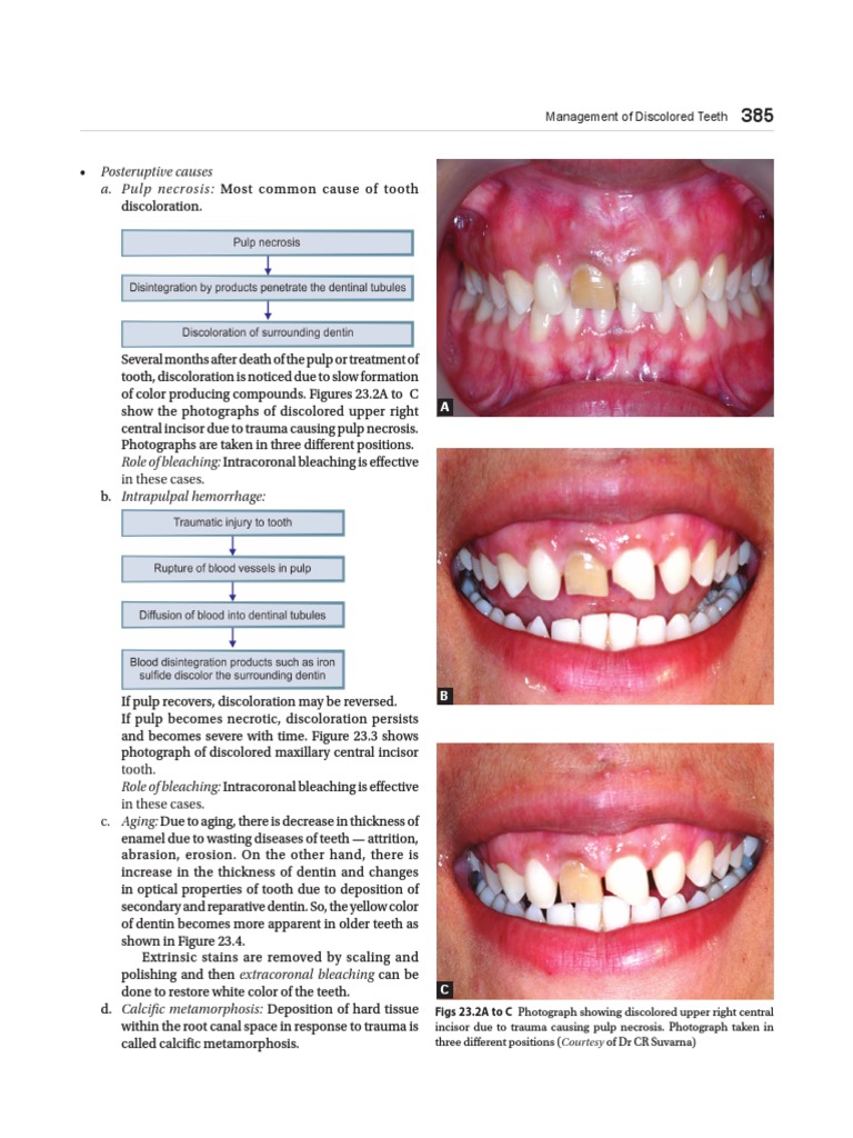 A. Pulp Necrosis: Most Common Cause of Tooth: Management of Discolored ...