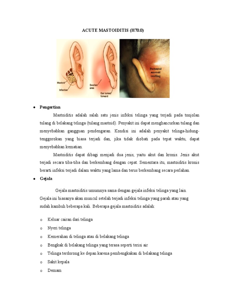 Acute Mastoiditis | PDF