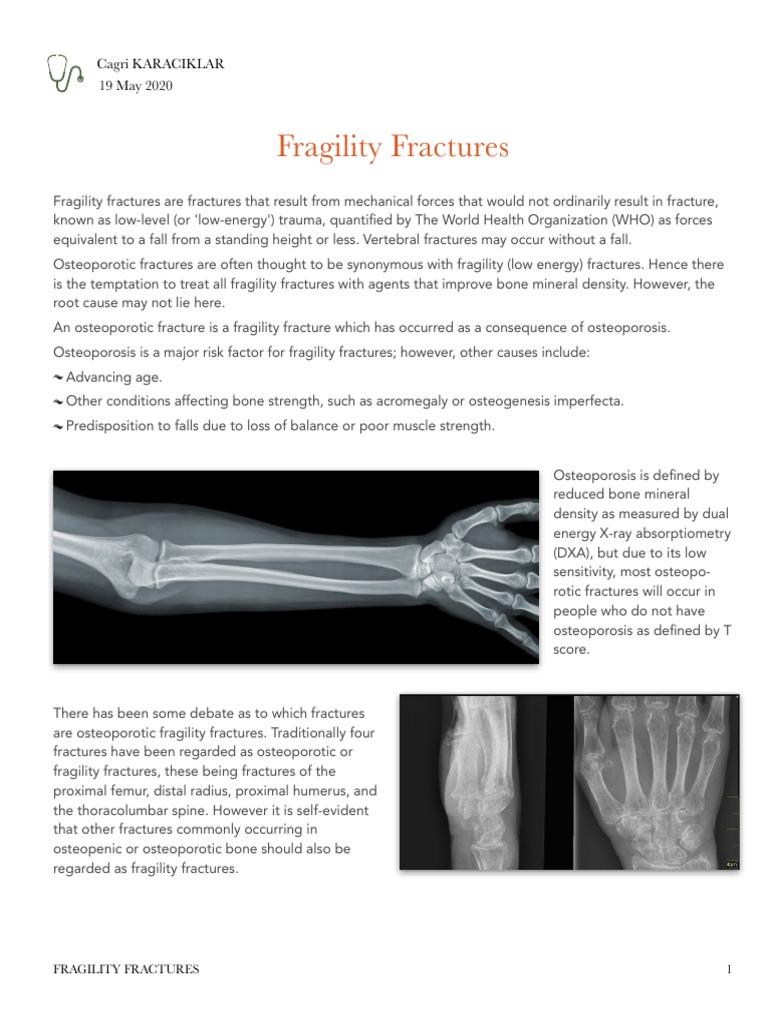 Cagri Karaciklar Fragility Fractures Essay | PDF | Osteoporosis | Bone