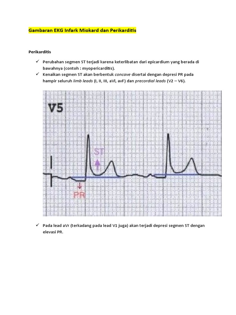 Gambaran EKG Infark Miokard Dan Perikarditis | PDF | Seni