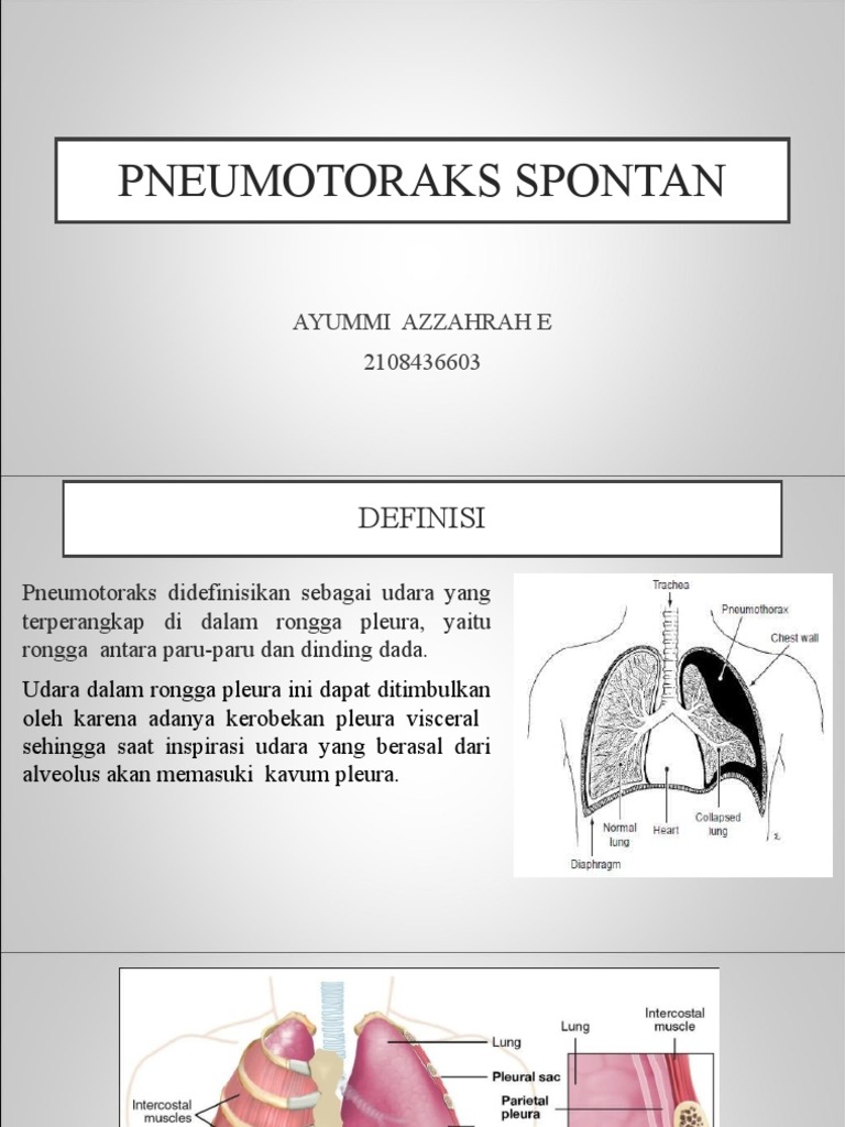 Pneumothorax Spontan | PDF