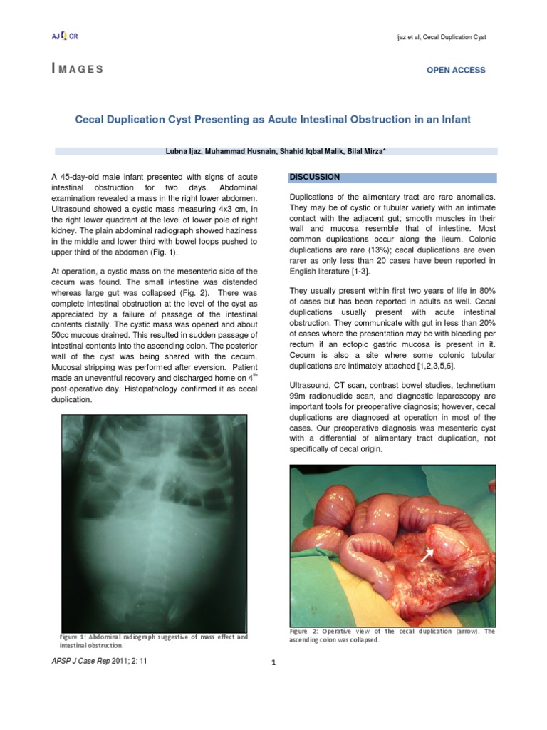 Cecal Duplication Cyst Presenting As Acute Intestinal Obstruction in An ...