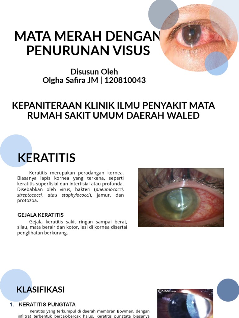 MATA MERAH DENGAN PENURUNAN VISUS - Olgha Safira JM | PDF
