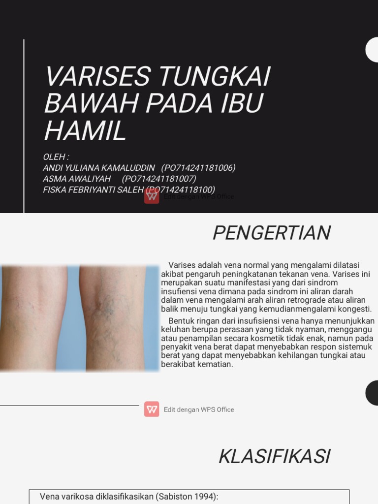 Kelompok 6 Varises Pada Ibu Hamil | PDF