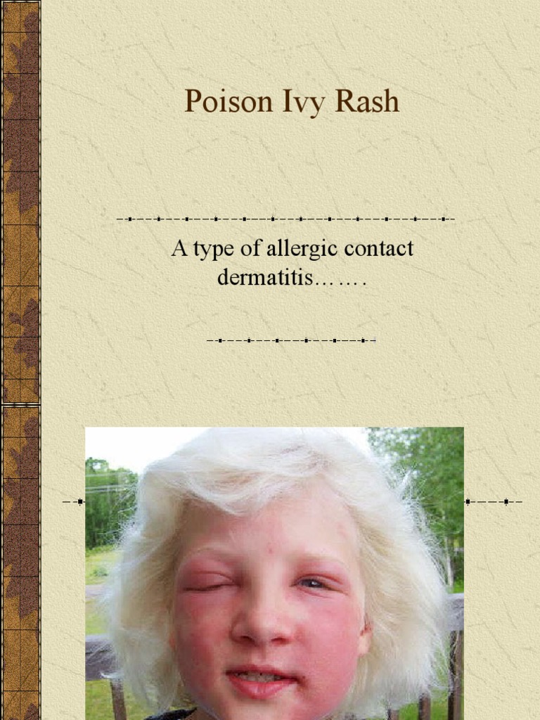 Poison Ivy Rash: A Type of Allergic Contact Dermatitis | PDF