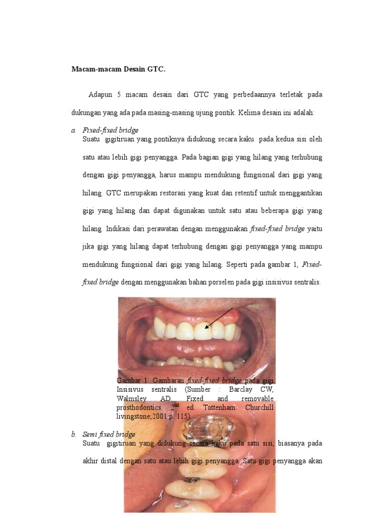 Desain GTC: Jenis-Jenis Jembatan Gigi | PDF