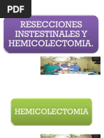 Colectomia y Reseccion Intestinal | PDF