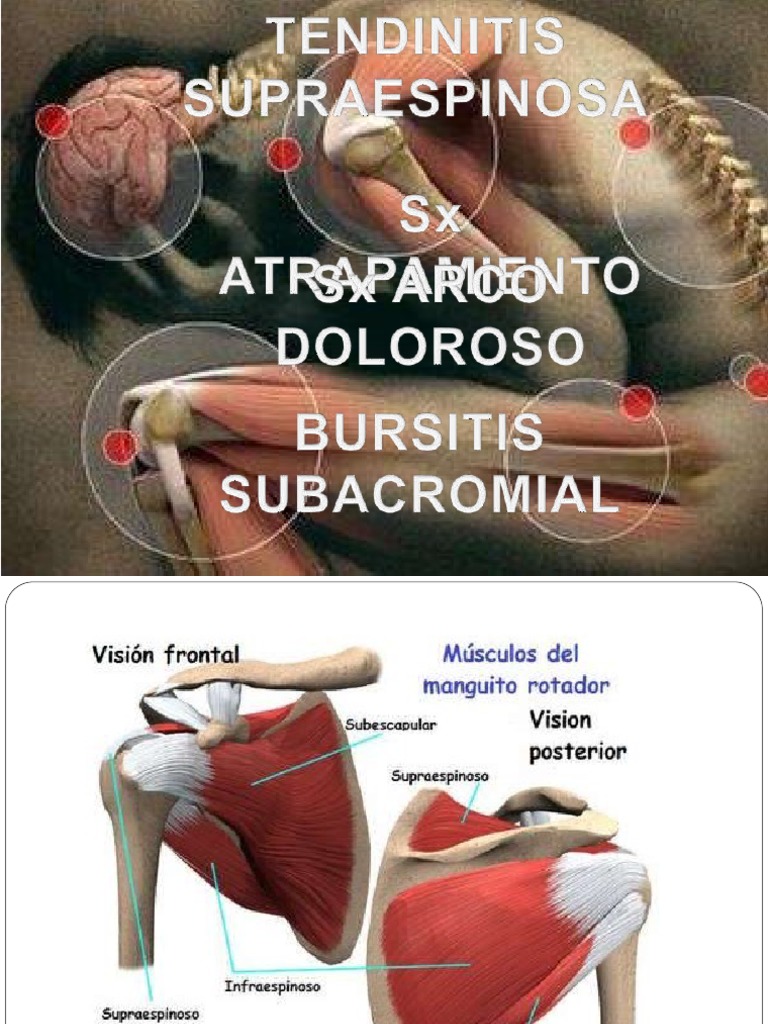 Bursitis Hombro | PDF