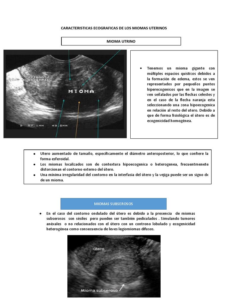 Caracteristicas Ecograficas de Los Miomas Uterinos.. | PDF