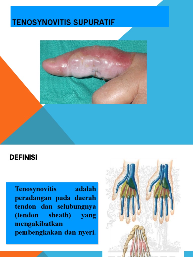 Tenosynovitis Supuratif | PDF