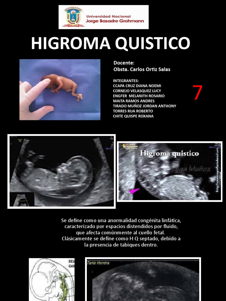 Higroma Quístico Fetal: Diagnóstico y Pronóstico | PDF | Ciencias de la ...