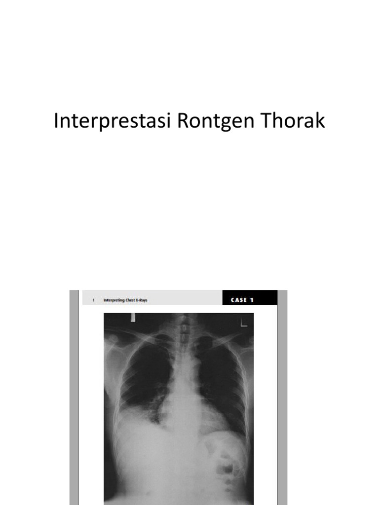 Interprestasi Rontgen Thorak | PDF