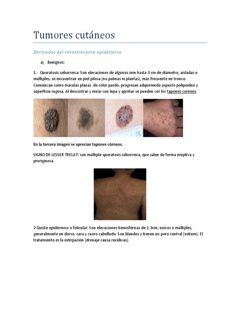 Tumores cutáneos: clasificación, características y presentación clínica | PDF | Melanoma | Piel