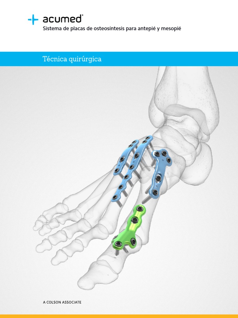 Acumed Surgical Technique ES Locking Forefoot Midfoot ESLEX00 03 B ...