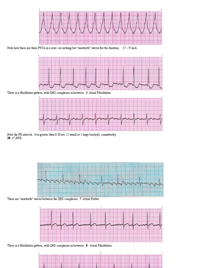 ECG Patterns and Arrhythmias Explained | PDF | Art | Science & Mathematics
