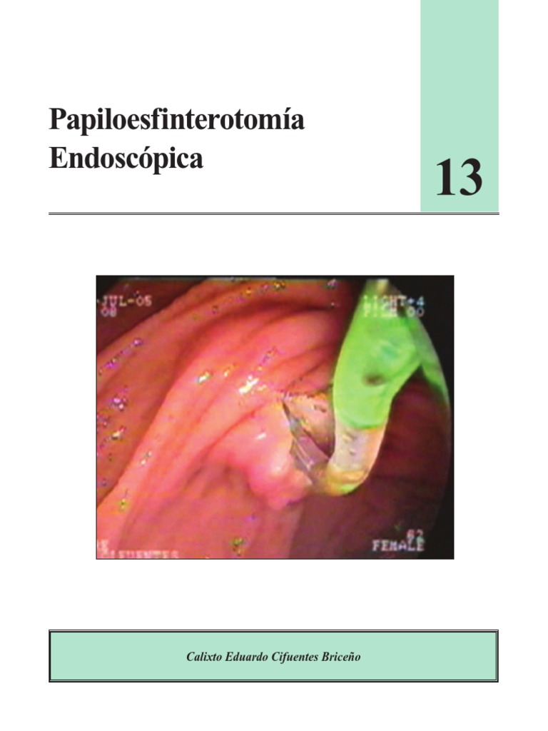 Esfinterotomía Endoscópica: Guía Clínica | PDF | Gastroenterología ...