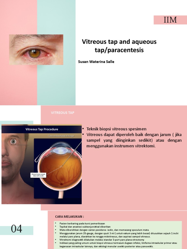 Aquoeus Tap Paracintesis & Vitreous Tap With Needle Susan | PDF