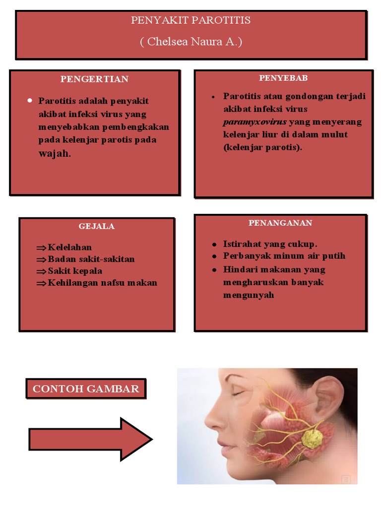 Parotitis: Gejala dan Penanganan | PDF