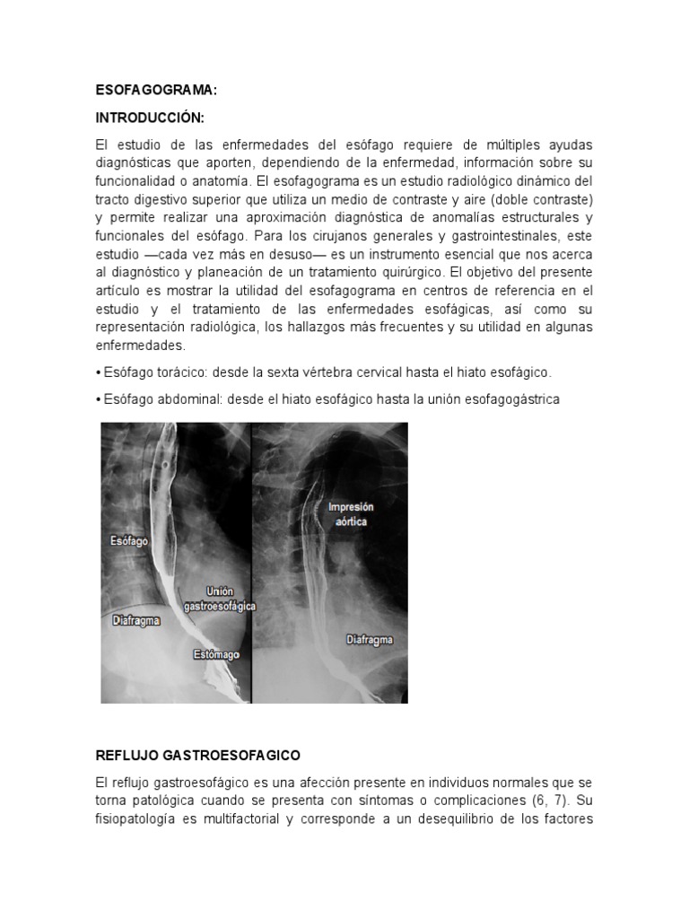 ESOFAGOGRAMA | PDF | La enfermedad por reflujo gastroesofágico | Cáncer