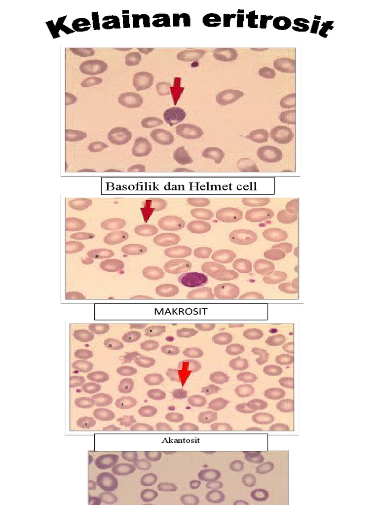 Gambar Kelainan Eritrosit Pdf