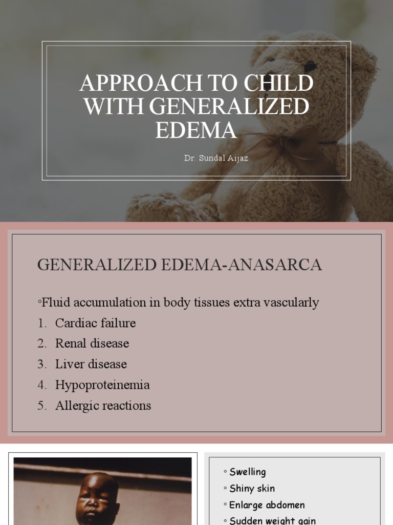Approach To Child With Generalized Edema: Dr. Sundal Aijaz | PDF ...