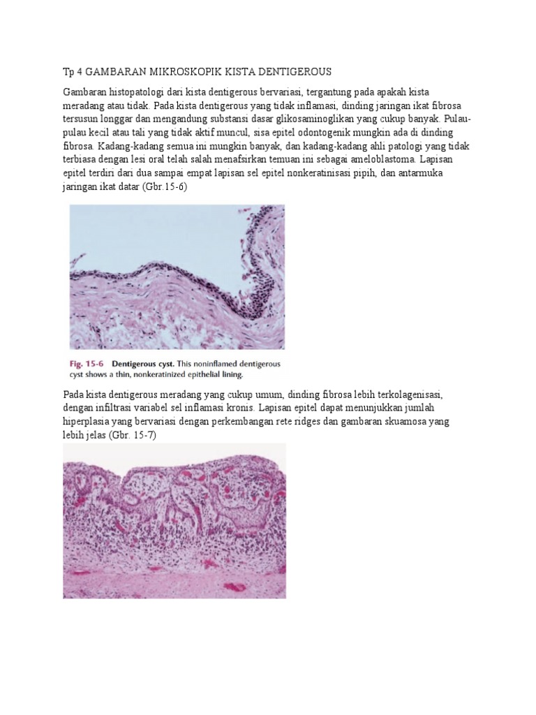 TP 4 GAMBARAN MIKROSKOPIK KISTA DENTIGEROUS | PDF