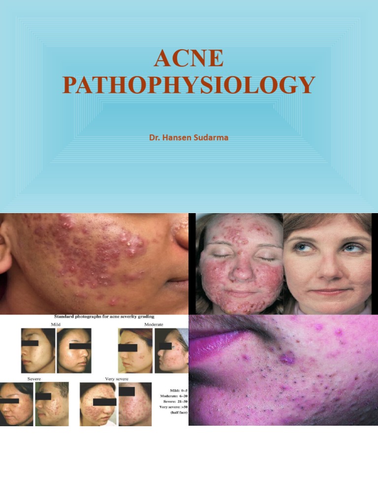 Acne Pathophysiology | PDF
