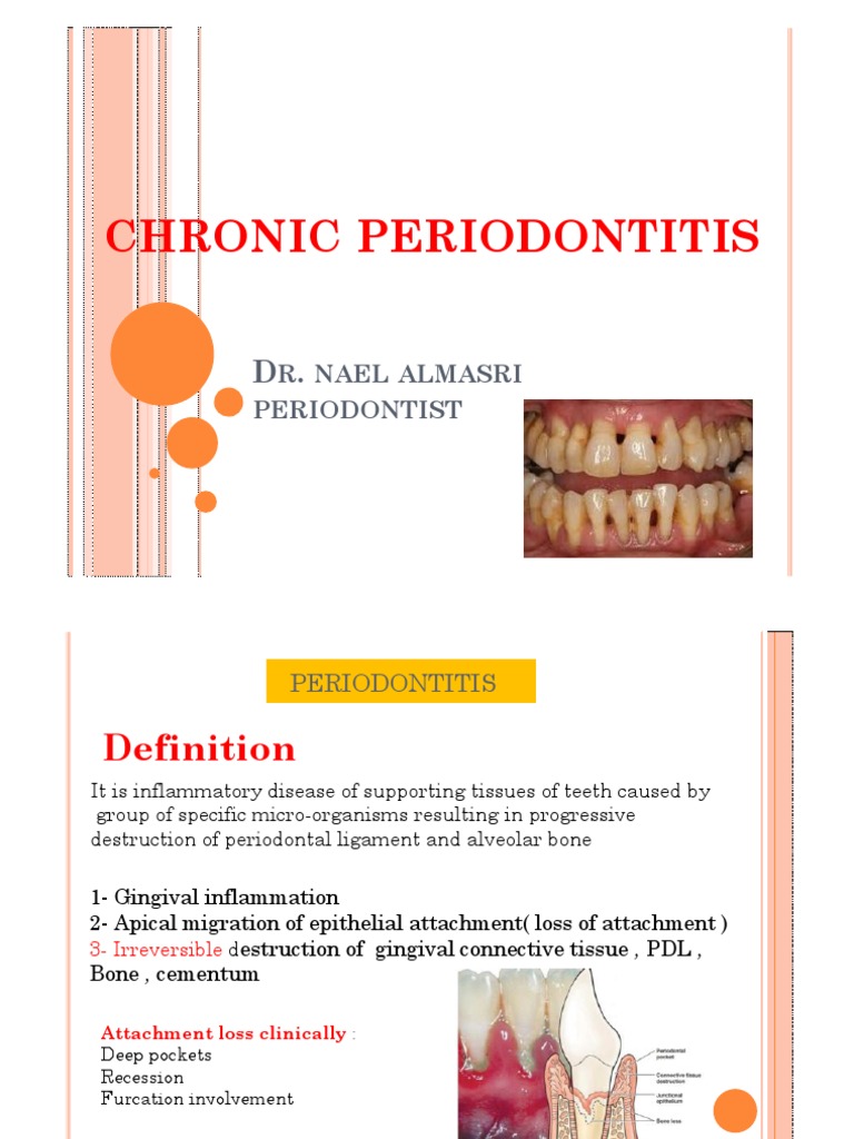 Chronic Periodontitis: R Nael Almasri Periodontist | PDF ...
