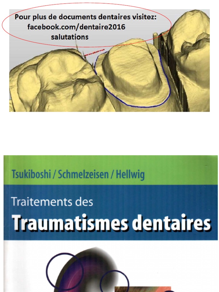 Traitements Des Traumatismes Dentaire | PDF