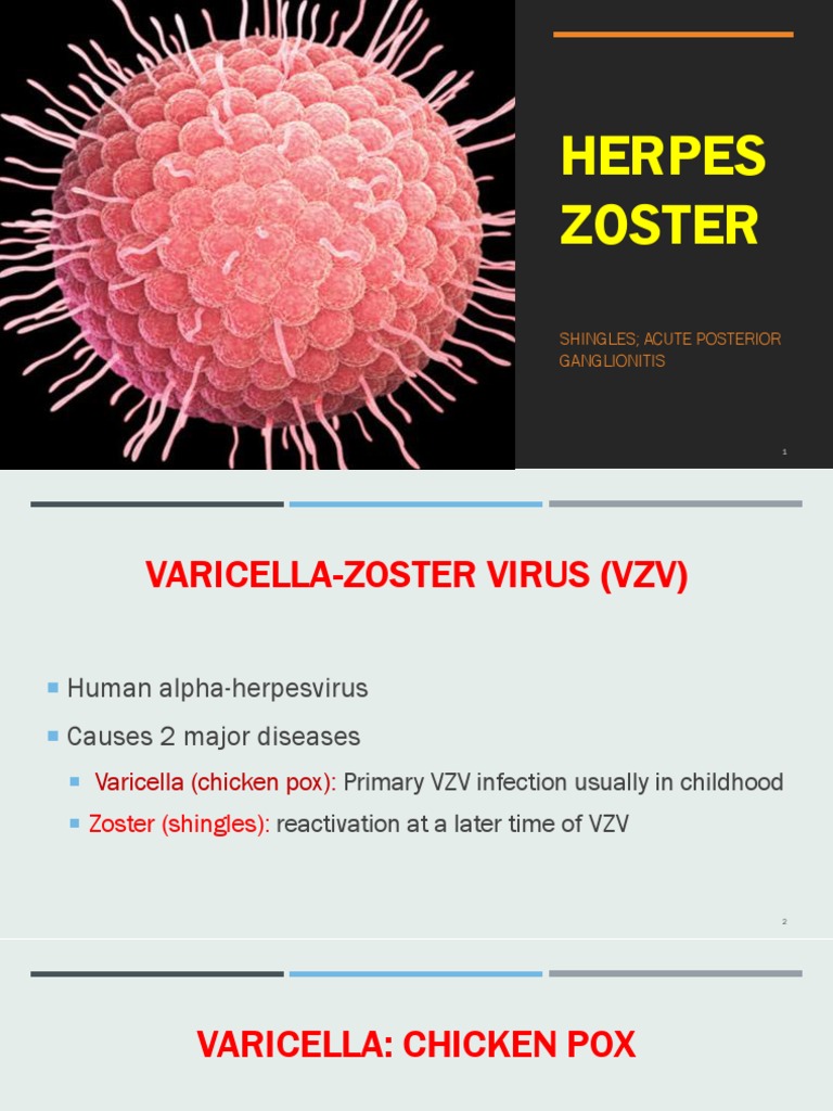Herpes Zoster: Shingles Acute Posterior Ganglionitis | PDF | Herpes ...